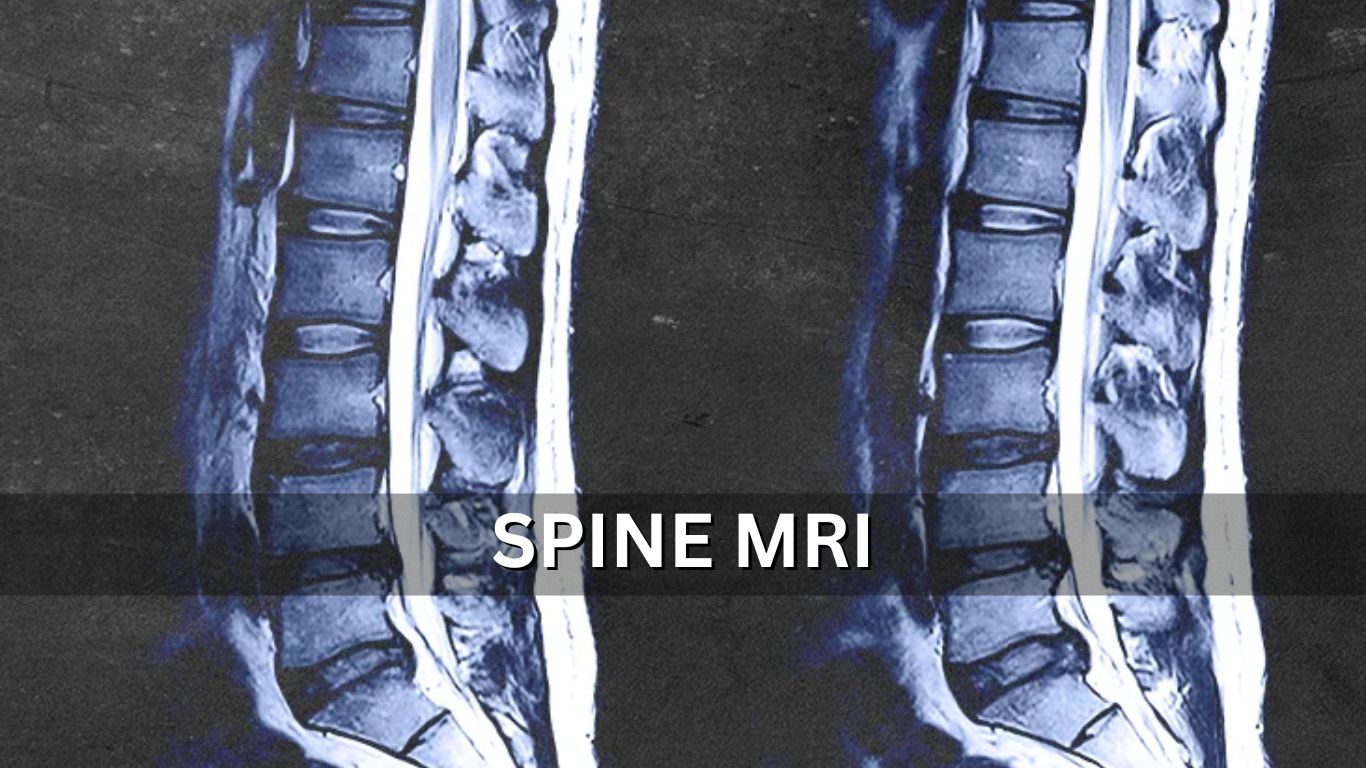 Spine MRI: Why Is It Done & What Can It Diagnose?