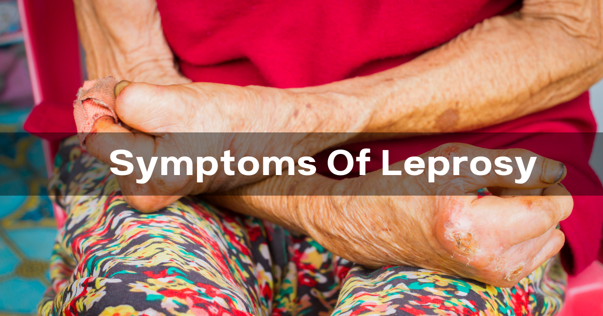 7 Symptoms of Leprosy You Need to Know About